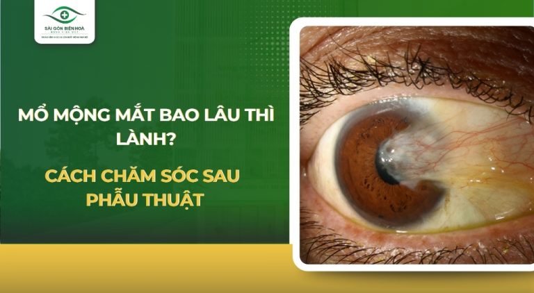 Mổ mộng mắt bao lâu thì lành? Cách chăm sóc sau phẫu thuật