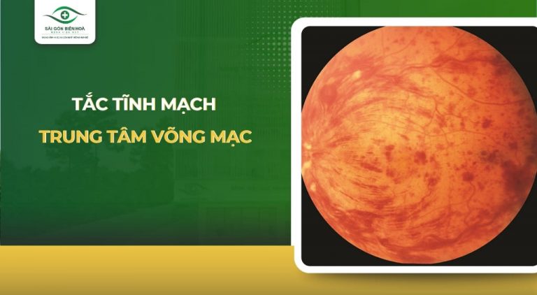 Tắc tĩnh mạch trung tâm võng mạc: Nguyên nhân, triệu chứng