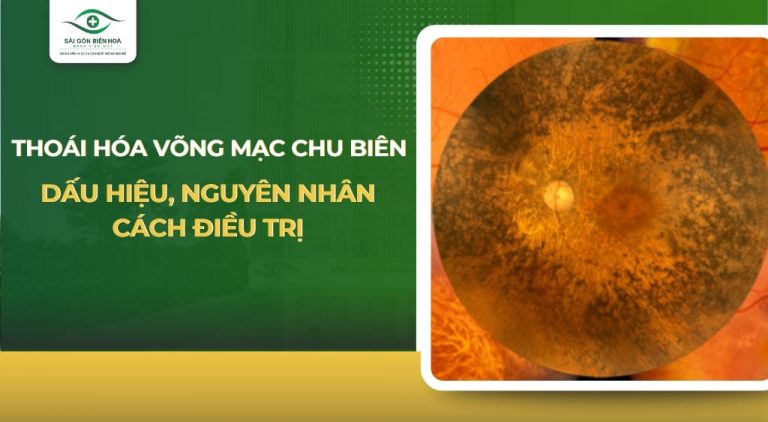 Thoái hóa võng mạc chu biên: Dấu hiệu, nguyên nhân, cách điều trị